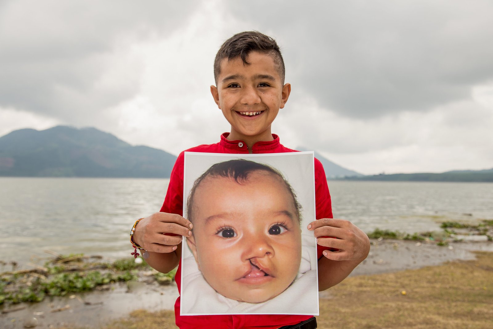 Smile Train comparte estudio sobre desnutrición en niños con LPH